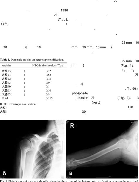 Figure 2 From A Heterotopic Ossification In The Subscapularis Muscle Case Report Semantic
