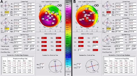 Topometric Difference Map Comparing The Anterior Curvature Parameters