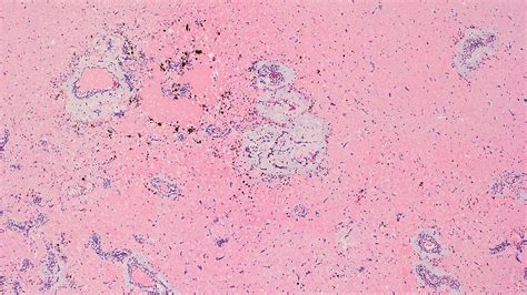 Heart Pathology