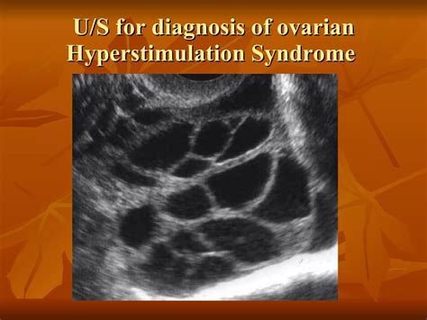 Ovarian Hyperstimulation Syndrome Ppt