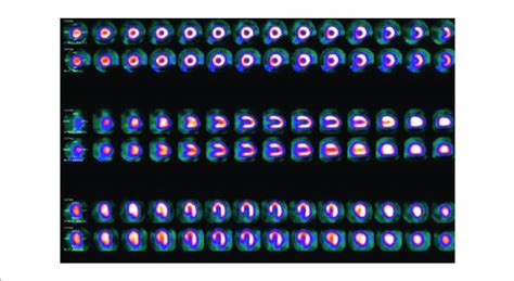 Case 1 Myocardial Perfusion Scintigraphy Within Normality Images Download Scientific Diagram