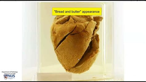 Heart Fibrinous Pericarditis Youtube