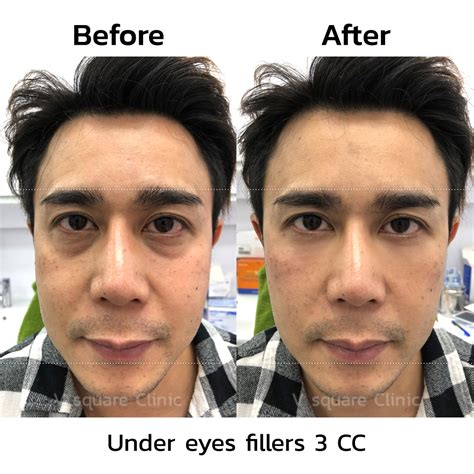 Under Eye Filler Before And After Male At Ali Oshanassy Blog