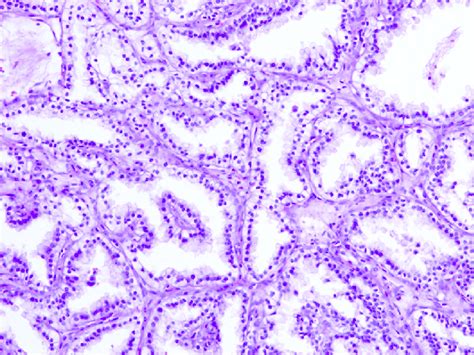 Renal Papillary Cell Carcinoma Differentiation Of Papillary Renal Cell