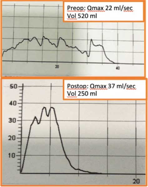 Pre And Postoperative Uroflow Curves Note The Non Specific