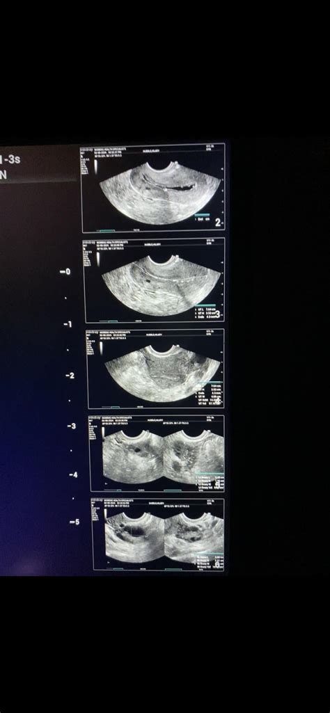 Transvaginal Pelvic Exam R Diagnoseme