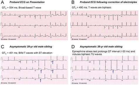 12 Lead ECG Of Proband And Sibling QTc Prolongation Was Observed Download Scientific Diagram