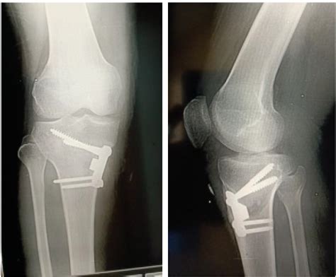 Figure 8 From Open Wedge High Tibial Osteotomy For Treatment Of Varus Knee Open Wedge High