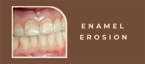Enamel Erosion What Causes Tooth Enamel Loss And How To Protect It