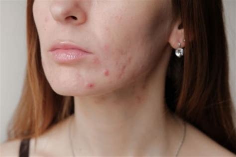 How Long Does It Take For A Pimple To Go Away