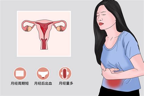 功能失调性子宫出血