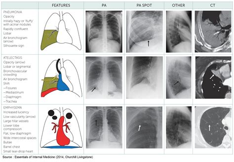 Radiographic Features Of Pulmonary Diseases Emergency Medicine Kenya Foundation