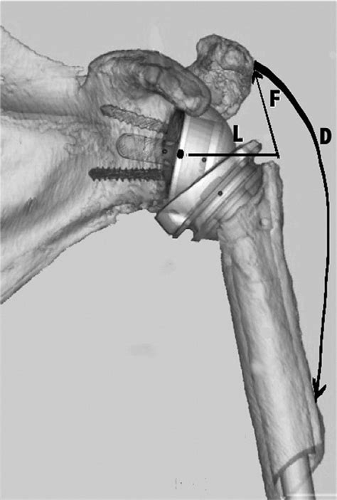 Distalization And Medialization Of The Center Of Rotation And Humerus