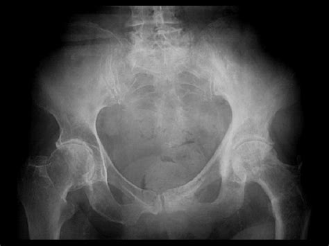 Anterior Shoulder Dislocation Findings Inferomedial Subcoracoid Displacement Of