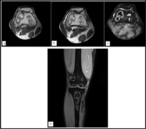 Bone Infarcts Mimicking Malignancy Avoiding Misdiagnosis