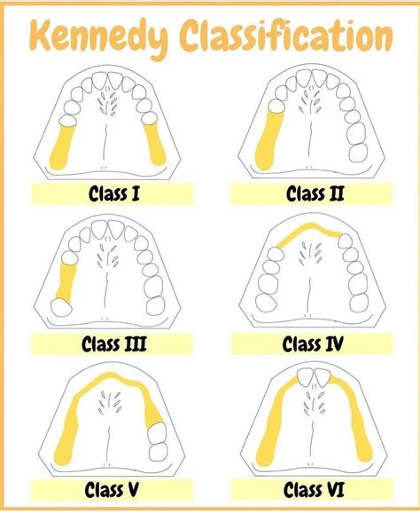 Kennedy Classification Medizzy