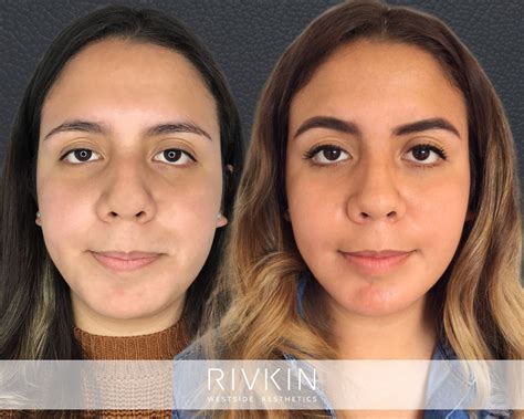 Hispanic Nose Types