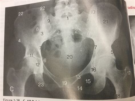 Radiographic Anatomy II Pelvis AP Flashcards Quizlet