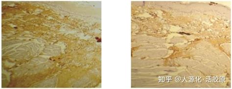 如何应对老年人口腔黏膜变化，预防口腔癌！重组Ⅲ型人源化胶原蛋白预防口腔病变区域的继发感染！ 知乎