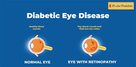 Diabetic Eye Diseases Dr Lal Pathlabs Blogs
