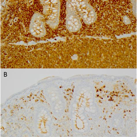 Kappa Lambda 20 The Infiltrate Demonstrated Marked Lambda Download Scientific Diagram
