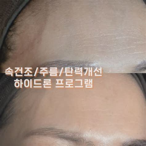 수원에스테틱 수원피부관리 Skin•body 테라피 And 브로우•왁싱 하이드론 안티에이징 프로젝트 울긋불긋 피부시술받은 티 나지 않고 솔루션앰플인젝으로 즉각적인