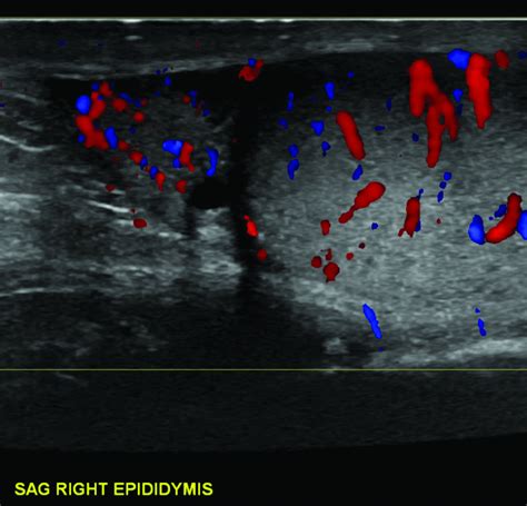 Imaging Testicular Torsion Applied Radiology