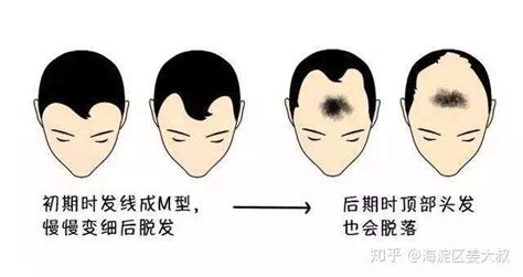 【经验】如何自己判断是不是雄性激素性脱发（雄脱），雄脱怎么办？ 知乎