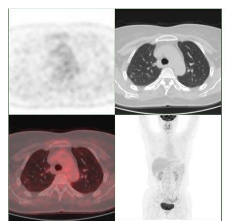 Figure 1 From Diagnosis Of Primary Lung Cancer And Benign Pulmonary Nodules A Comparison Of The