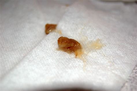 Natural Cures For Sinus Infection Natural Cures For Natural Cures
