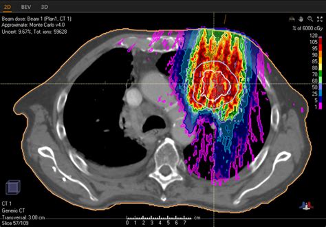 Proton Monte Carlo Dose Calculation In Raystation Raysearch Laboratories