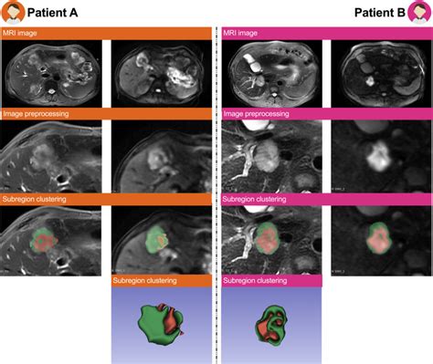 Mri Based Quantification Of Intratumoral Heterogeneity For Intrahepatic