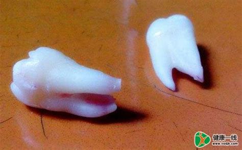 拔完四号牙怎么装上 随意云