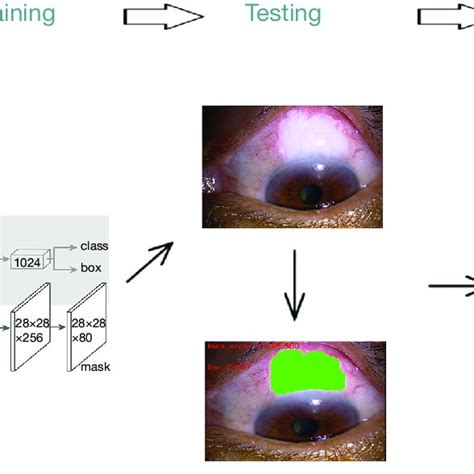 The Labeling Of A Functional Filtering Bleb In A Photograph The Ibags
