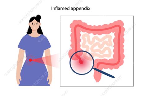 Inflamed Appendix Conceptual Illustration Stock Image F035 7127 Science Photo Library
