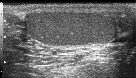 Limited Testicular Microlithiasis Tml Less Than 5 Per Field Of View