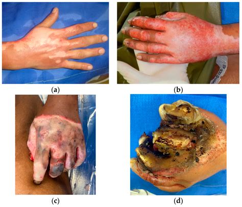 Acute Surgical And Rehabilitation Management Of Complex Hand Burns In