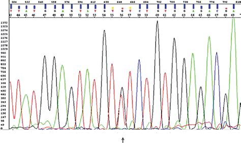 Figure 1 From Detection Of Jak2 V617f Mutation Increases The Diagnosis