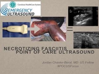 Finding Necrotizing Fasciitis In The Ed Pptx