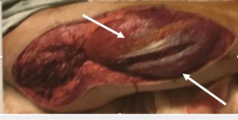 Muscle Bulge After Fasciotomy Of Gluteal Compartment Download Scientific Diagram