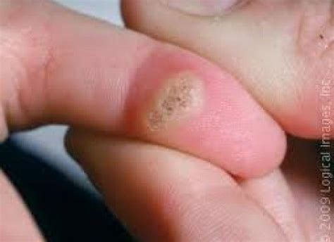 ΜΕΡΜΥΚΙΕΣ ΚΟΝΔΥΛΩΜΑΤΑ ΓΕΝΝΗΤΙΚΩΝ ΟΡΓΑΝΩΝ Health Fitness Health