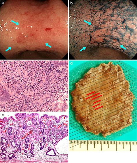 Endoscopic Diagnosis Of Gastric Cancer At Lee Porter Blog