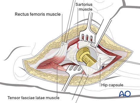 Orif Of Transverse Fractures For Spontaneous Acetabular Fracture