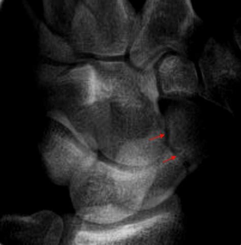 Schaphoidfraktur Lægehåndbogen På Sundhed Dk