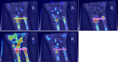 development and optimization of ai algorithms for wrist fracture