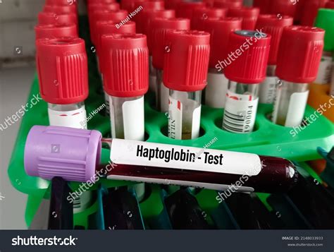 Lab Tests Online Haptoglobin At Alex Mckean Blog