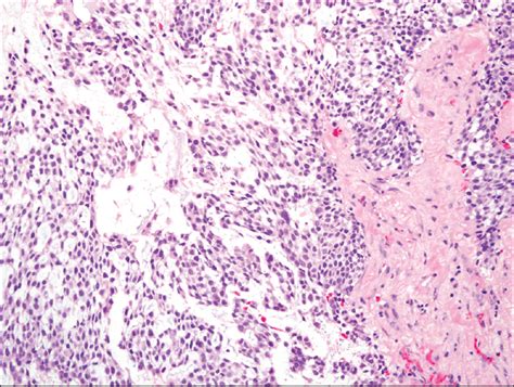 Pleural Fluid Metastases Of Myoepithelial Carcinoma A Case Report And
