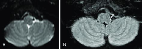A Diffusion Weighted Imaging Mri Shows Markedly Restricted Diffusion