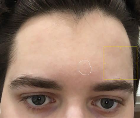 Best Treatment For Long Lasting Forehead Scar Acne Scars