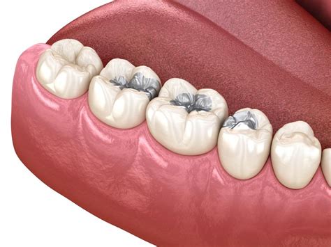 Dental Amalgam Fillings Advantages Disadvantages And Cost